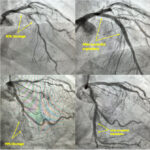 Coronary Angioplasty and Heart Stenting in Singapore | Dr. Leslie Tay