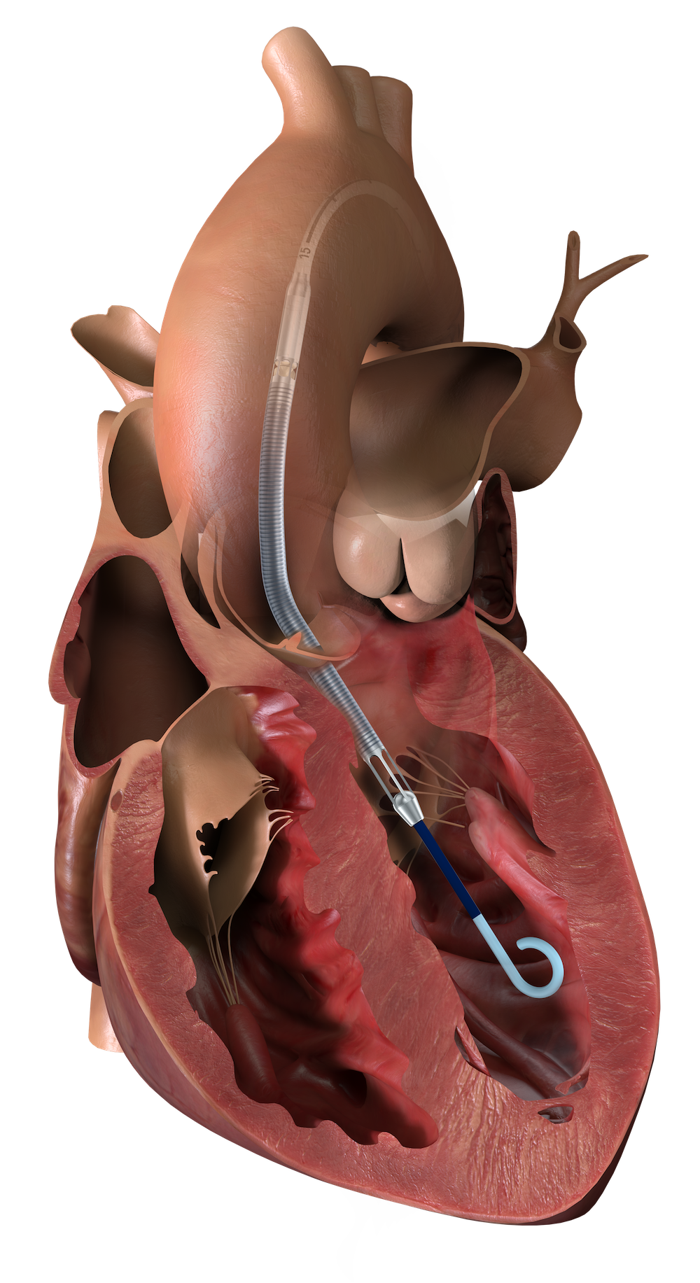 Impella Heart Pump for Coronary Angiogram Procedures | Leslie Tay Heart ...